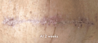 In-Use Video & Photos: INSORB Absorbable Subcuticular Skin Stapler